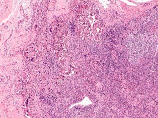 AstraZeneca’s SLE drug performs well in Phase III trial