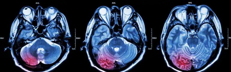 Delytact: The world's first oncolytic virotherapy for brain cancer ...