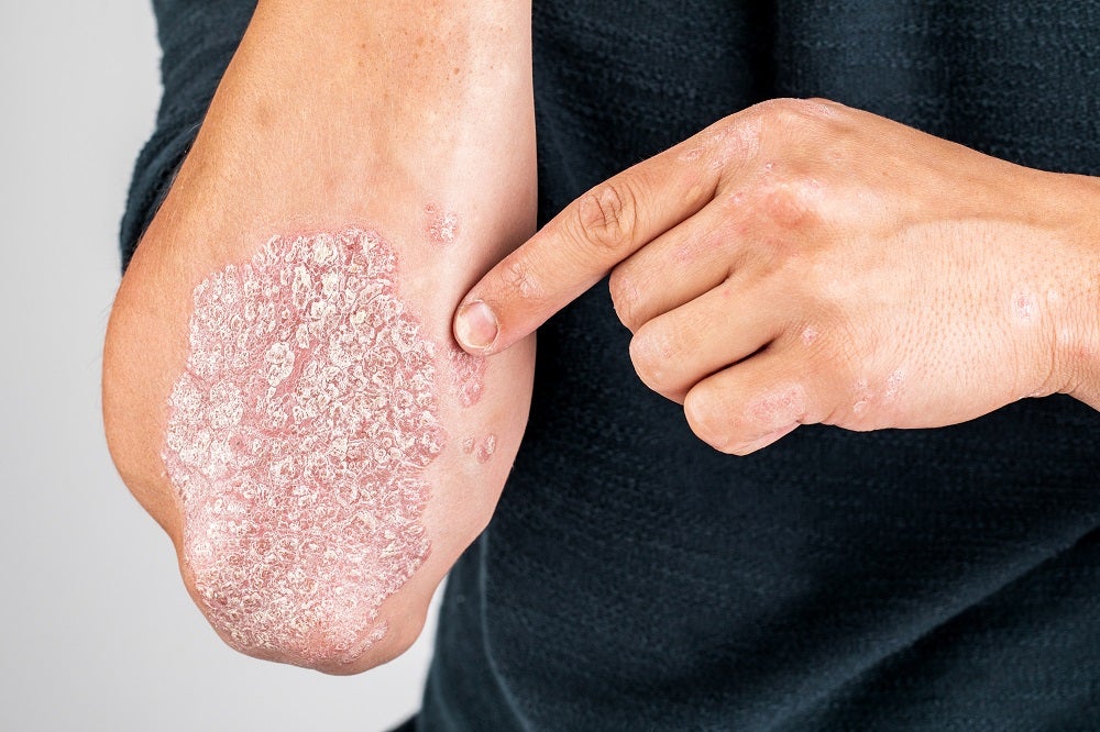 Targeted approaches needed in plaque psoriasis - Pharmaceutical Technology