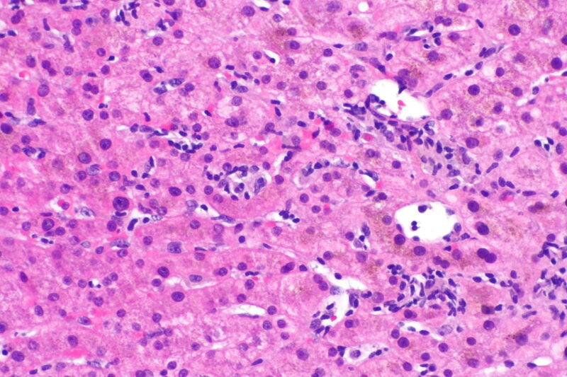 FDA grants Fast Track status for Pfizer’s NASH combination therapy