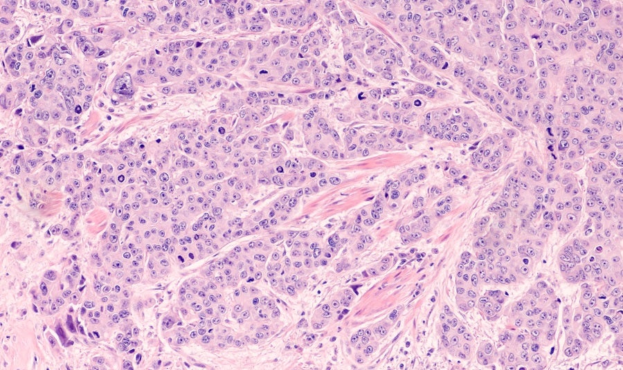 ImmunityBio moves closer to its first marketed drug but approval is ...