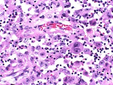 Moderna expands mRNA vaccine pipeline for shingles, HSV and cancer