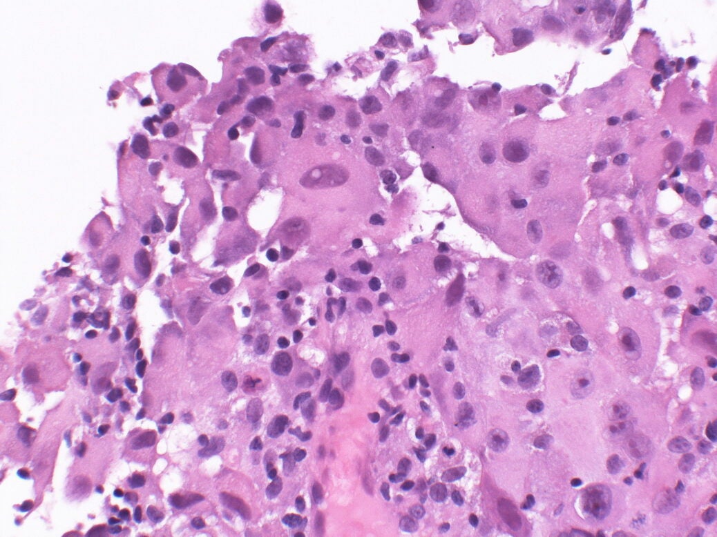 US FDA grants orphan drug status for Verismo’s mesothelioma therapy