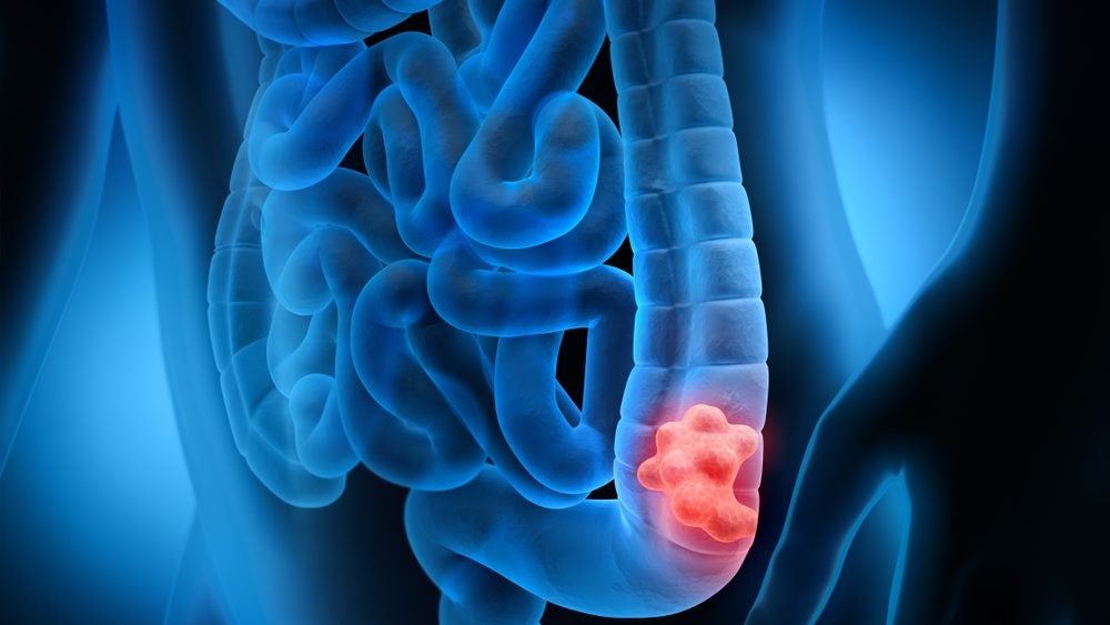 Biodexa gains license for polyposis asset as stock more than doubles ...