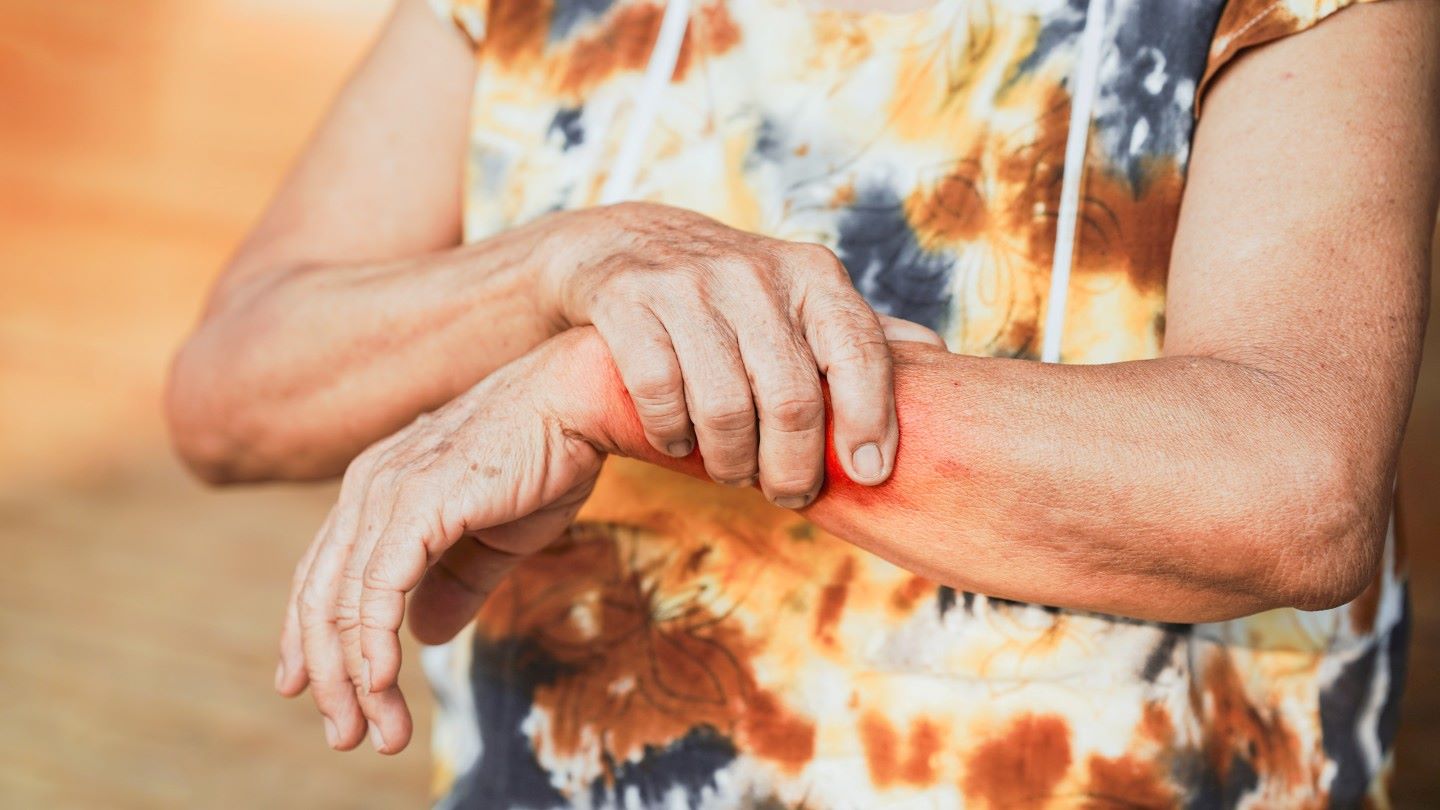 UCB’s BIMZELX gains FDA approval for inflammatory conditions