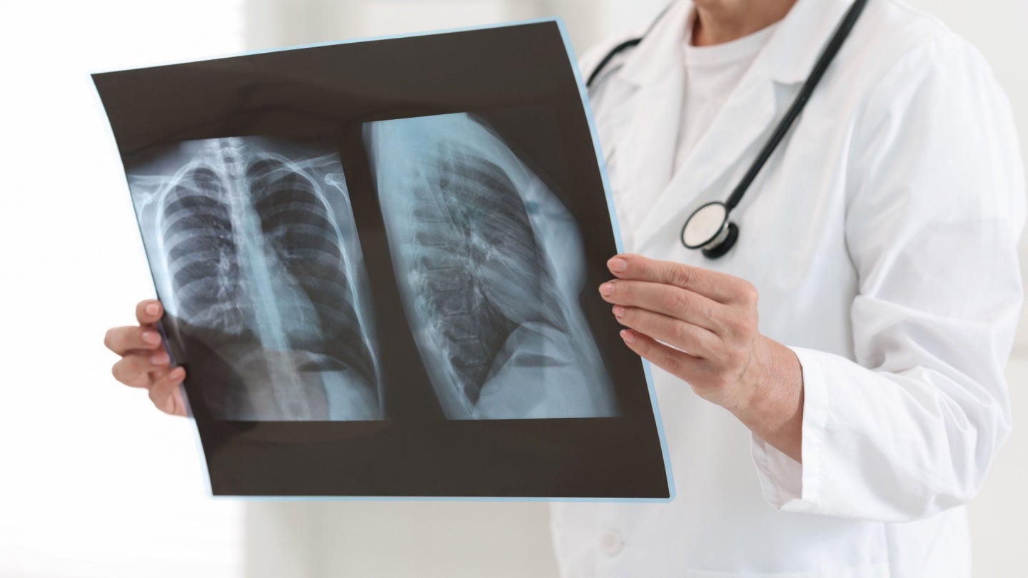 Meitheal gains US commercial rights for CABP treatment therapy