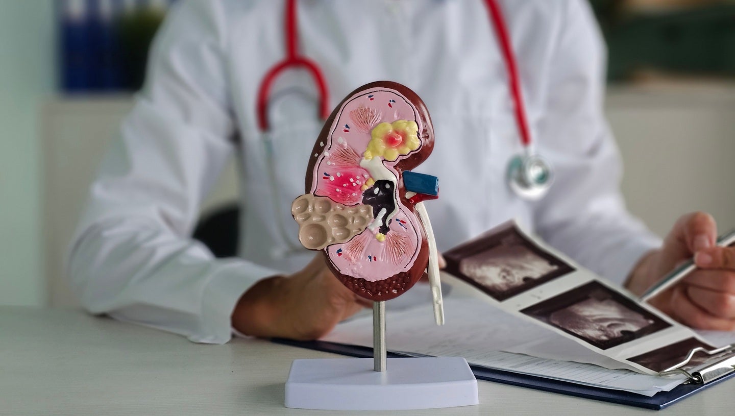Roche’s Gazyva receives approval from FDA for lupus nephritis